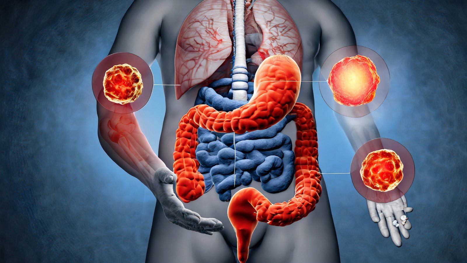 Colitis Crónica Tipos Causas Y Tratamiento Natural › Probimel